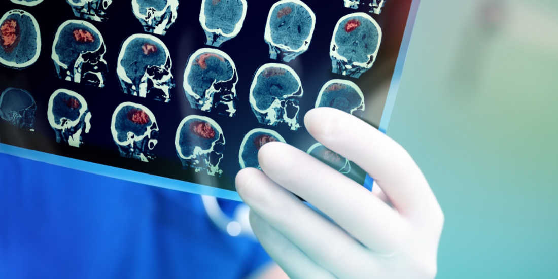 Curasight ready to move forward in brain cancer - Biostock